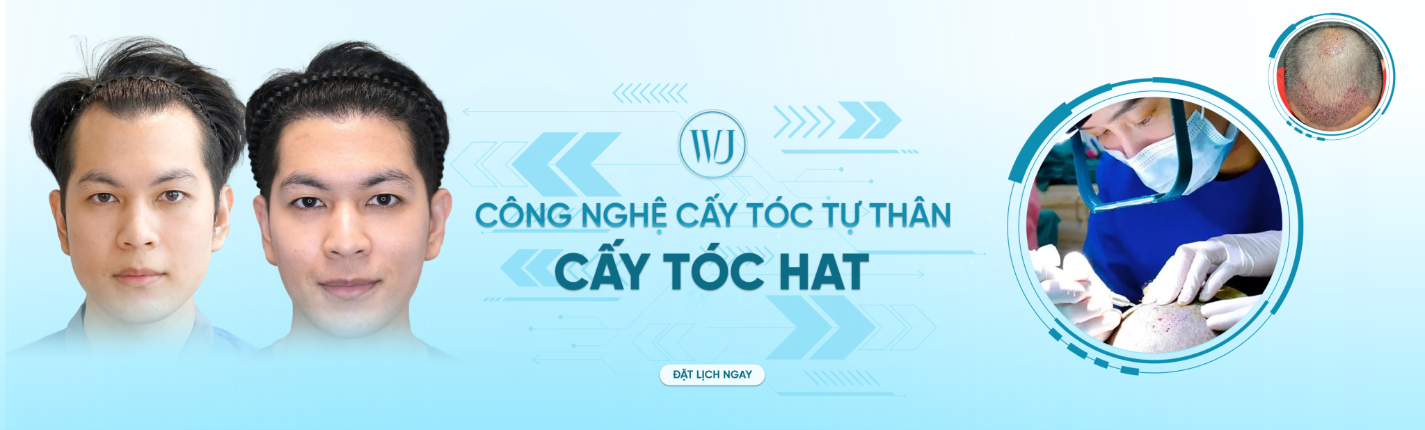 Dịch vụ – Viện Cấy Tóc Tự Thân WangJing